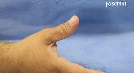 Tetik parmak nedir? Tetik parmak belirtileri nelerdir? Tedavi yöntemler ...