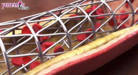 Anjiyo nedir? Stent nasıl ve kimlere takılır? Anjiyo sonrası neler ...